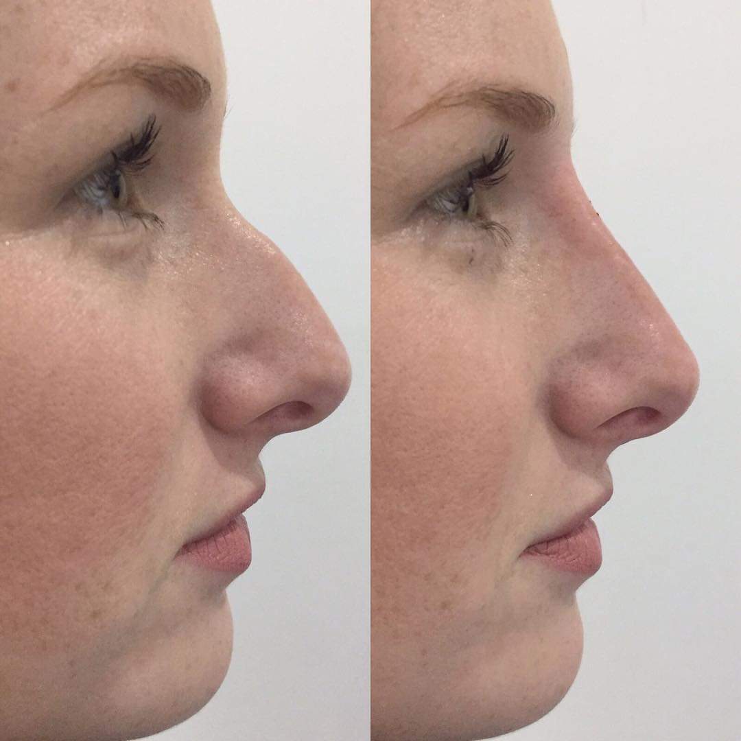(rhinoplasty) Nose Reshaping In Birmingham UK | Schon Aesthetic Ltd ...